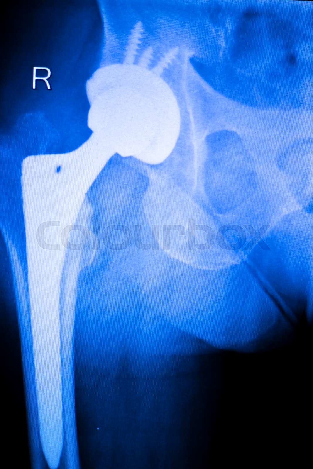 Hip replacement xray orthopedic medical scan | Stock image | Colourbox