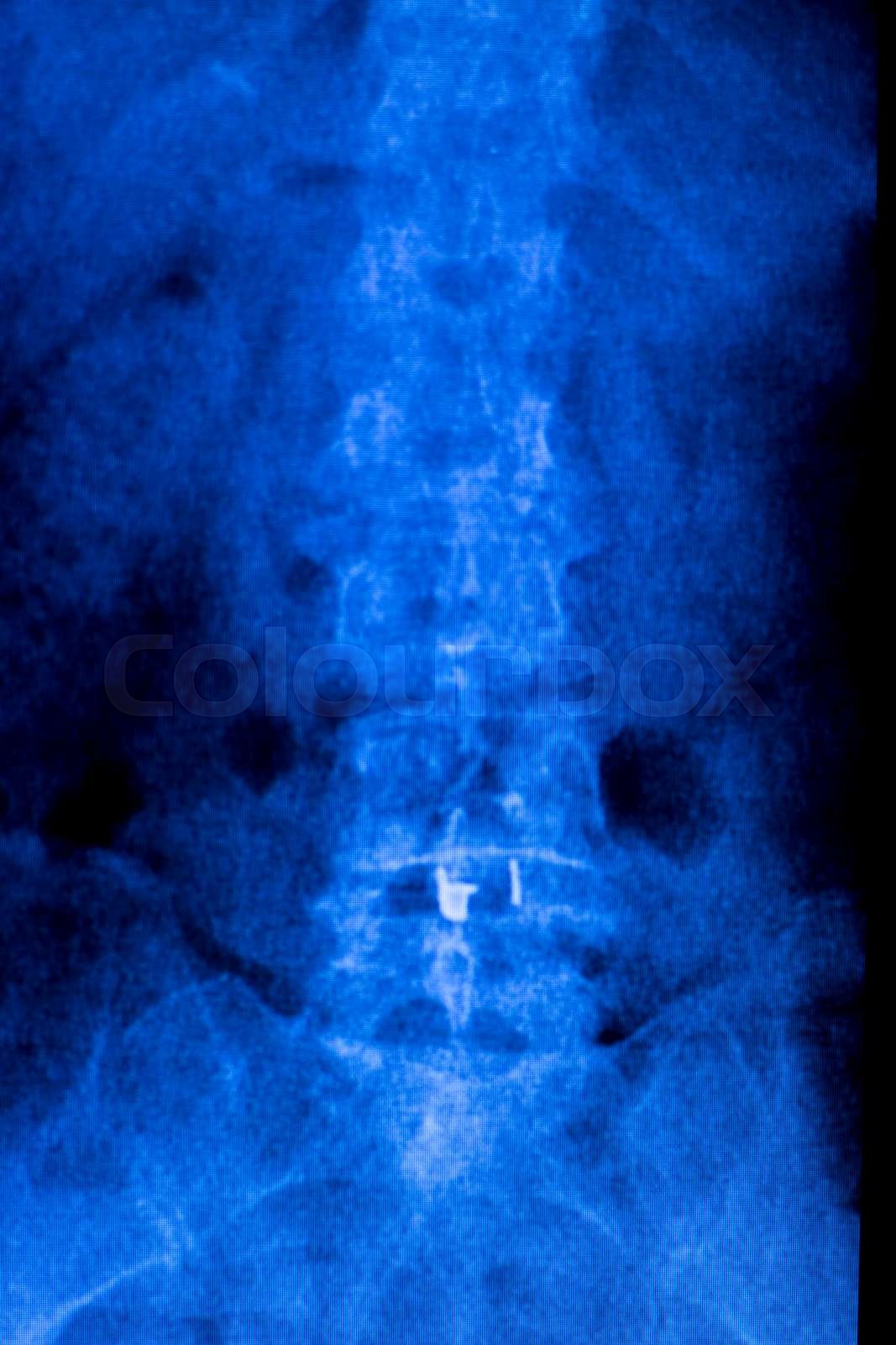 Spine vertebra back injury xray scan | Stock image | Colourbox