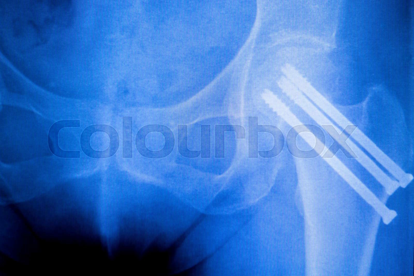 Hip replacement xray orthopedic medical scan | Stock image | Colourbox
