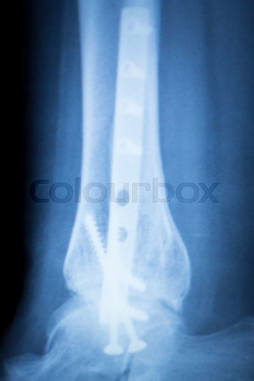 Ankle injury metal implant xray scan | Stock image | Colourbox