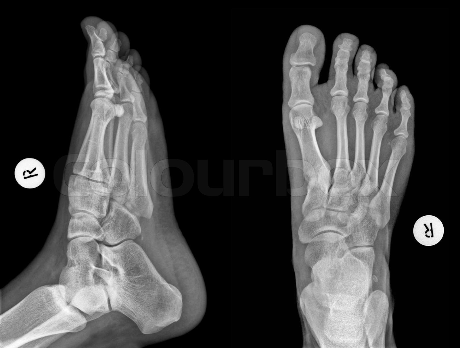 Detail Of An X ray Of A Foot Stock Image Colourbox Detail Of An X ray Of A Foot Stock Image Colourbox