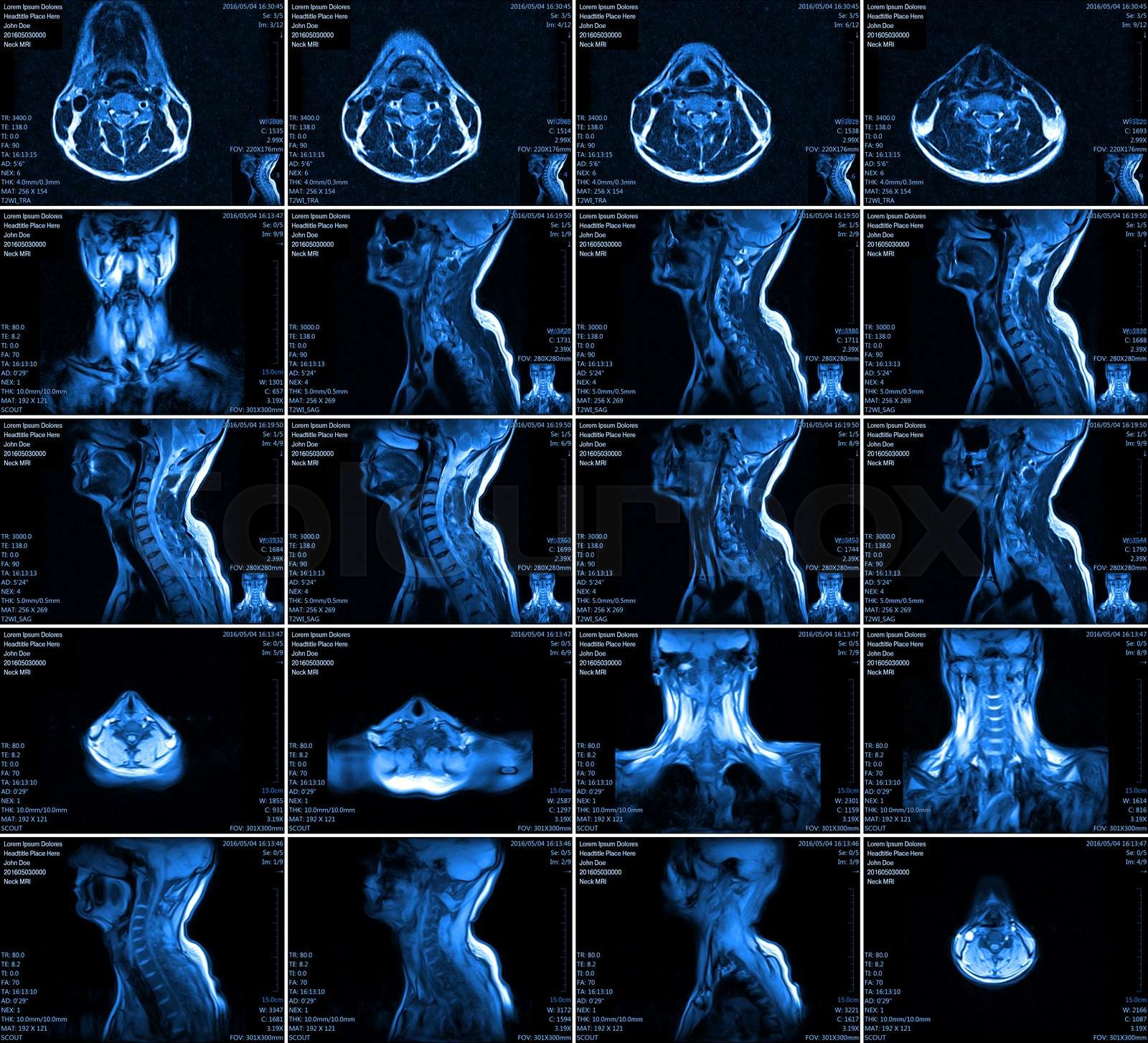 Magnetic resonance imaging of the cervical spine. | Stock image | Colourbox