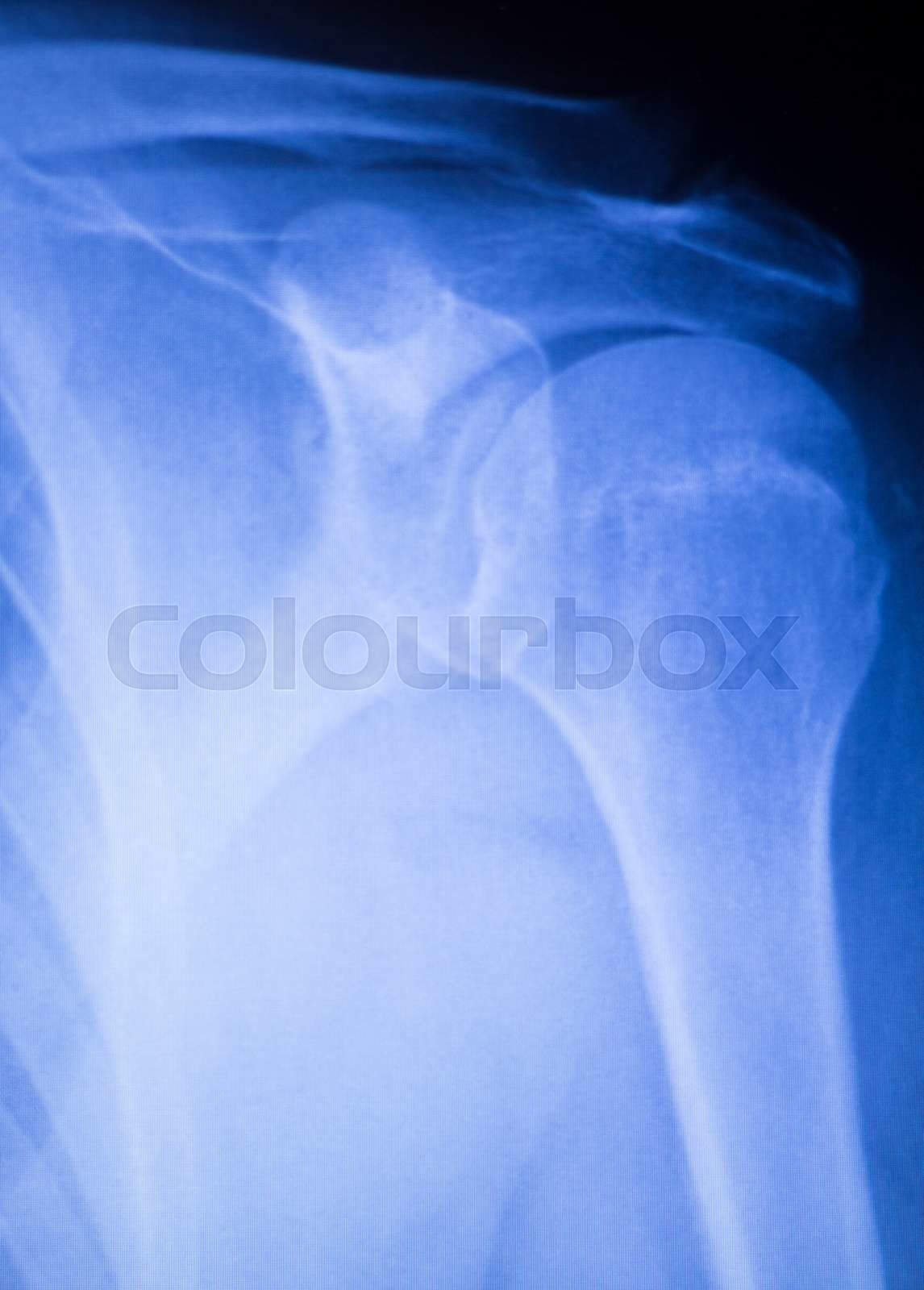 Shoulder joint orthopedic xray scan | Stock image | Colourbox