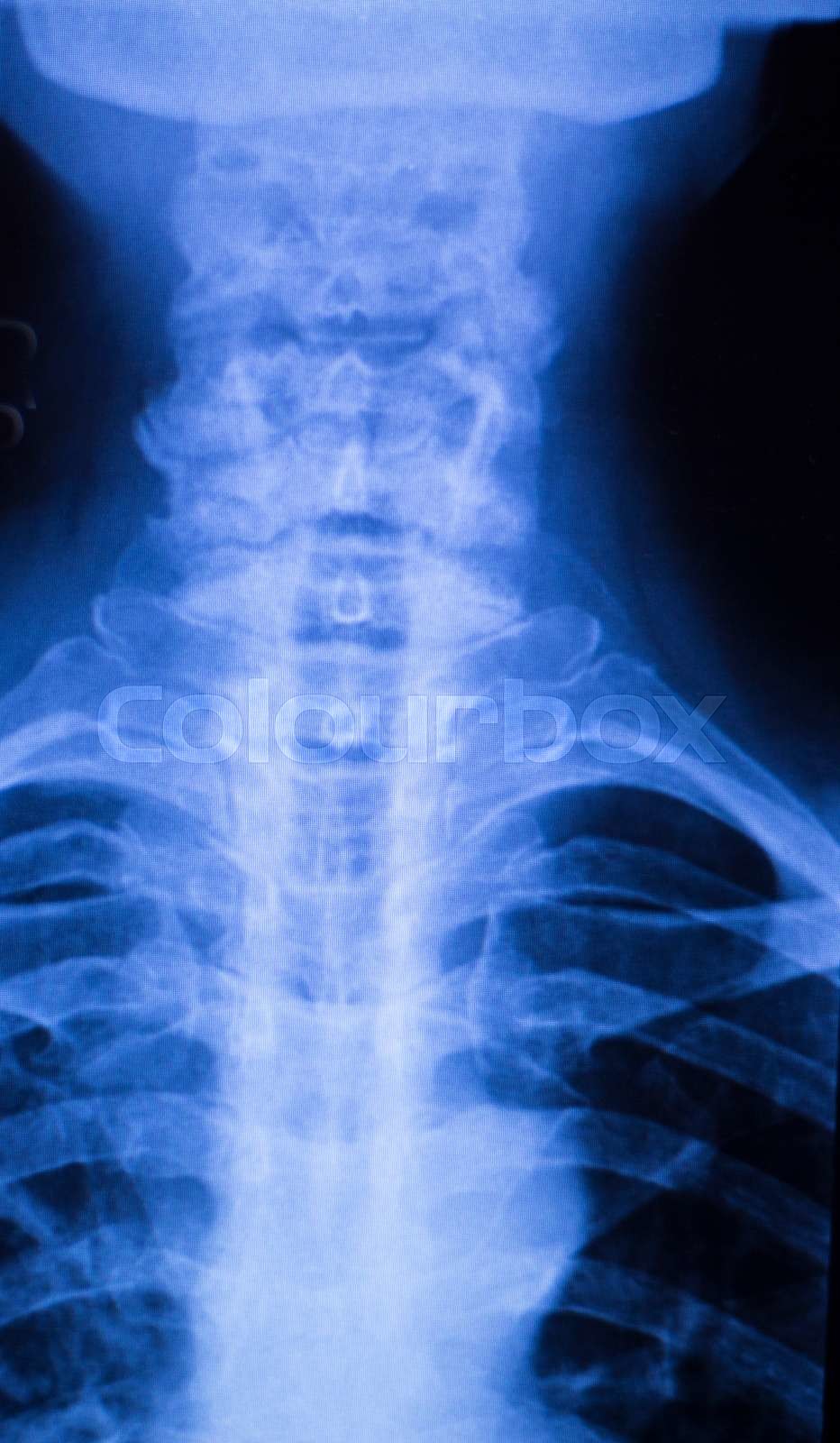 Neck and spine injury xray scan | Stock image | Colourbox