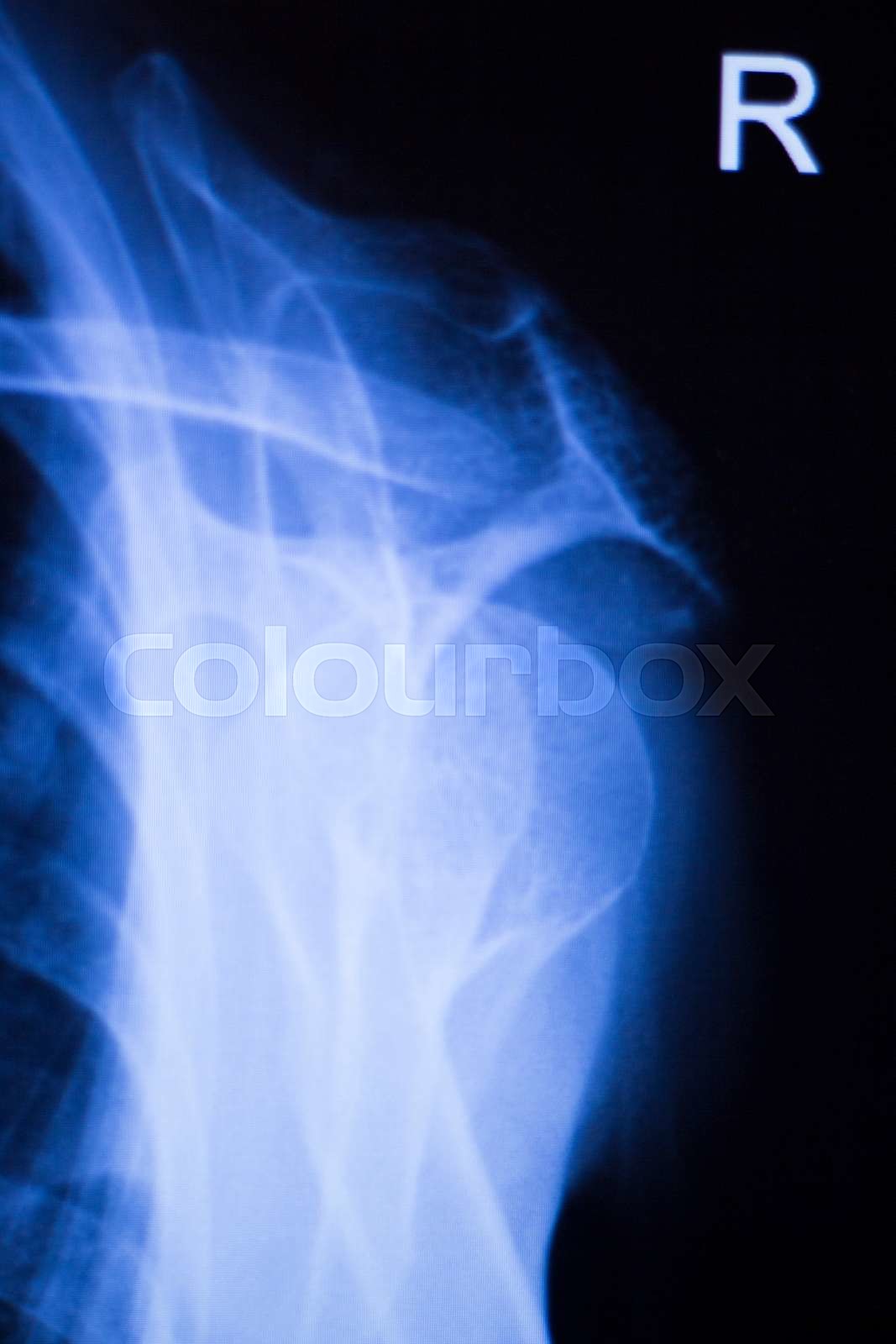 Shoulder joint orthopedic xray scan | Stock image | Colourbox
