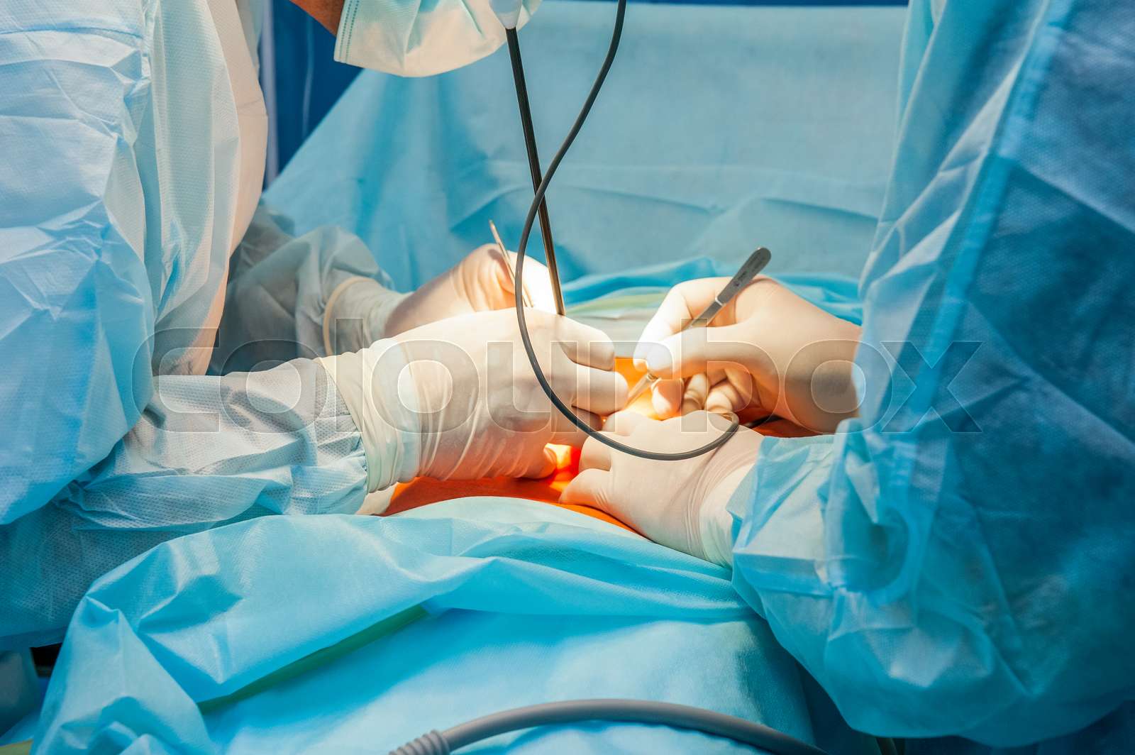 Complex laparoscopic operation on a peritoneal cavity is carried out in four hands | Stock image ...
