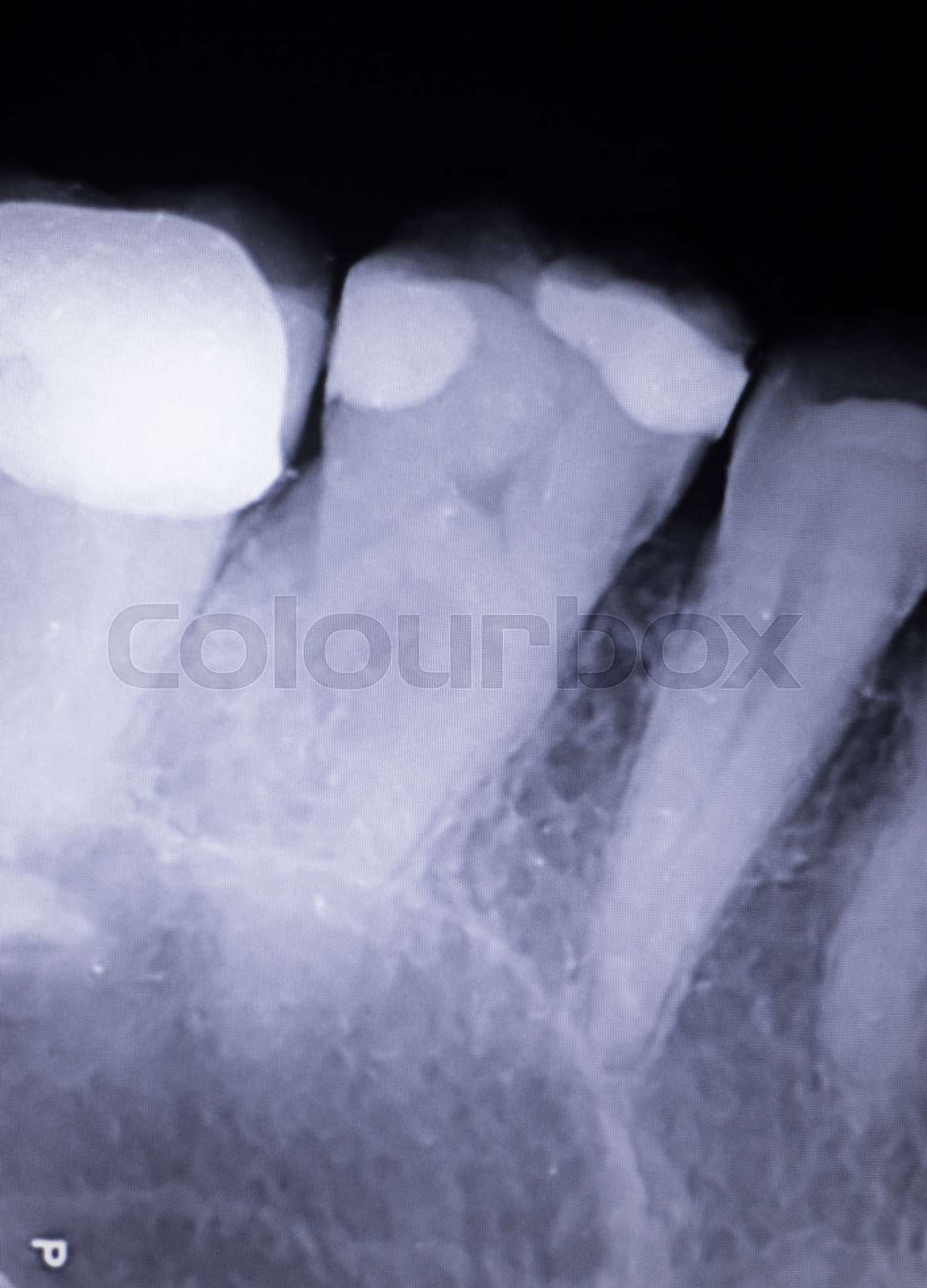 Tooth filling dental xray | Stock image | Colourbox