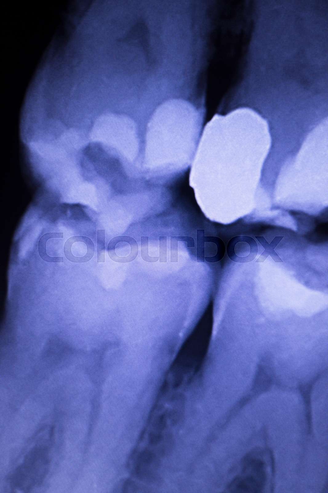 Tooth filling dental xray | Stock image | Colourbox