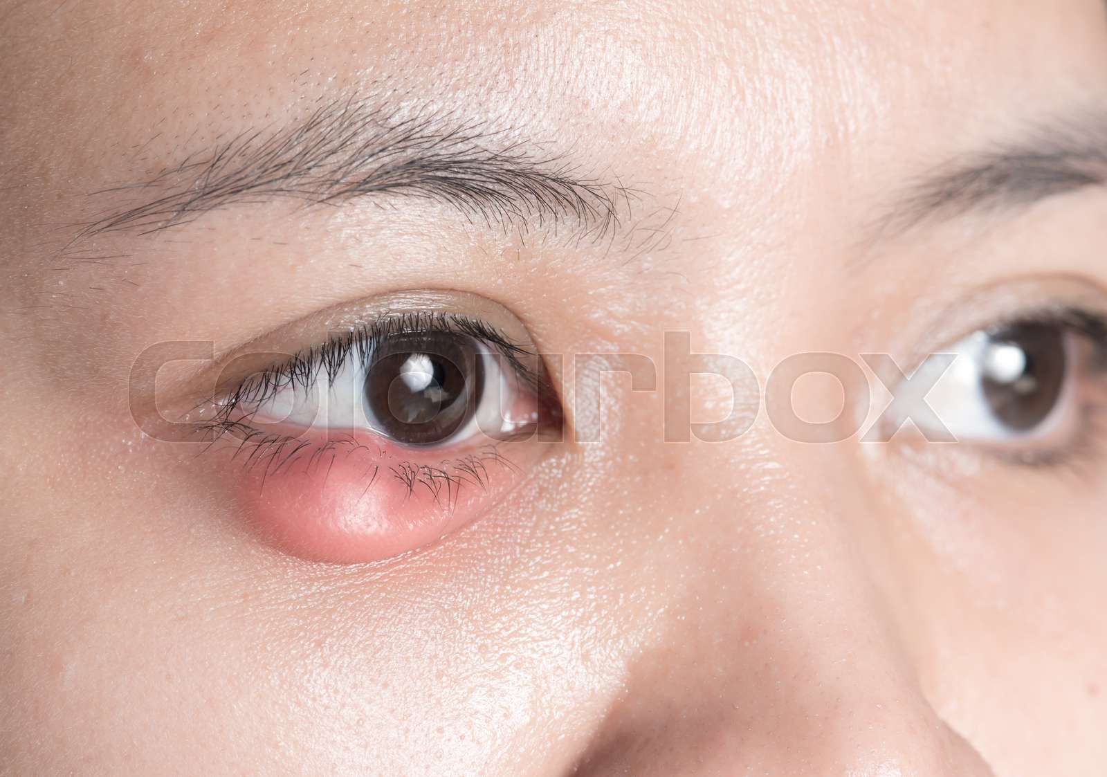 Close up of eyelid abscess (stye, hordeolum) | Stock image | Colourbox