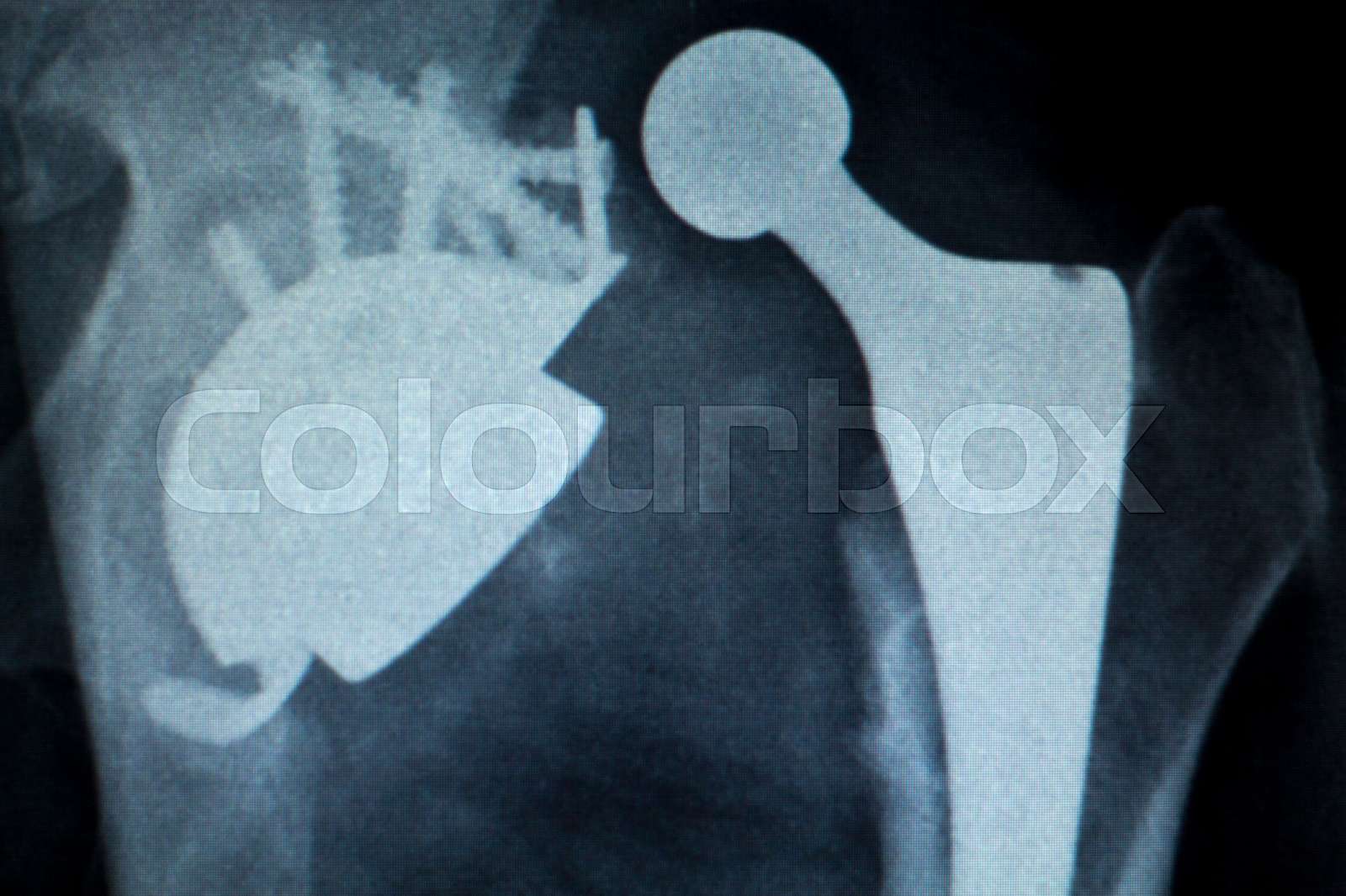 Hip replacement implant Xray scan | Stock image | Colourbox