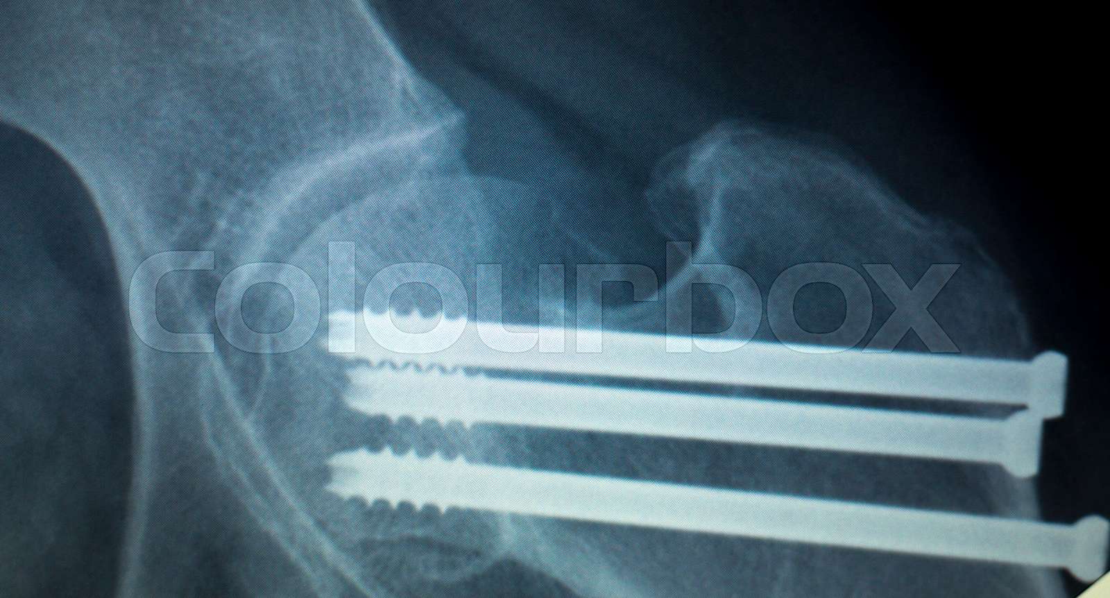 Hip screw implant Xray scan | Stock image | Colourbox