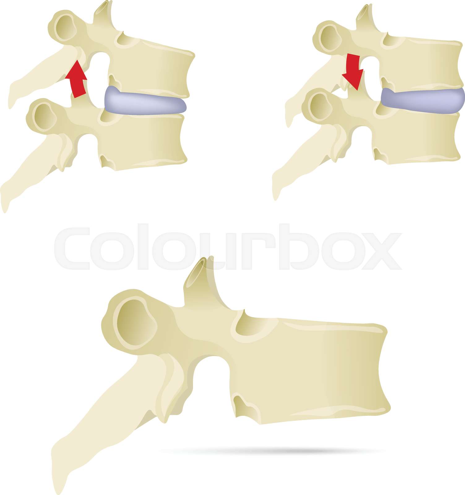 Spine, lumbar vertebra. Facet syndrome, advanced uncovertebral ...