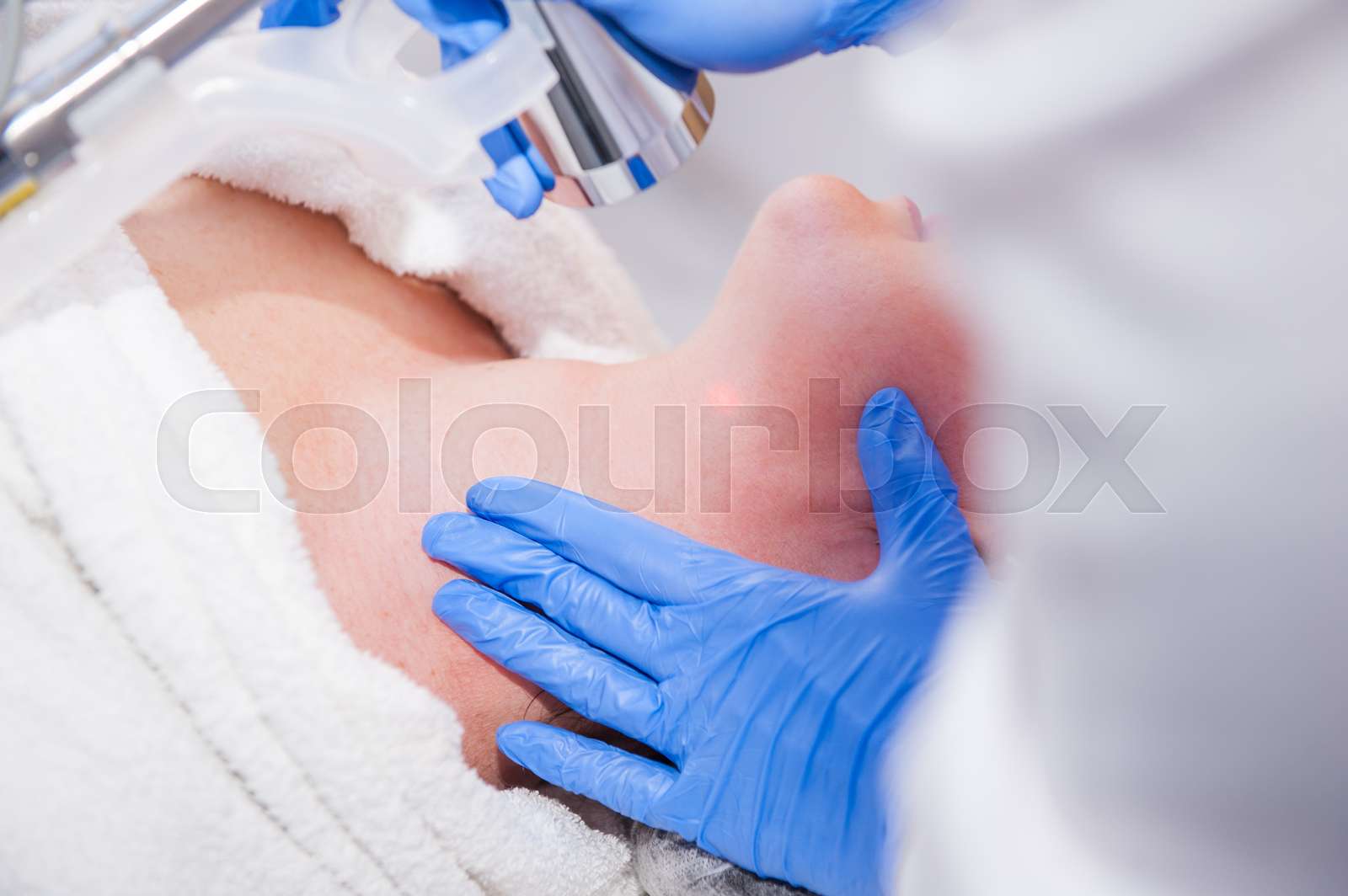 Close up process of laser peeling. Laser rejuvenation and skin ...