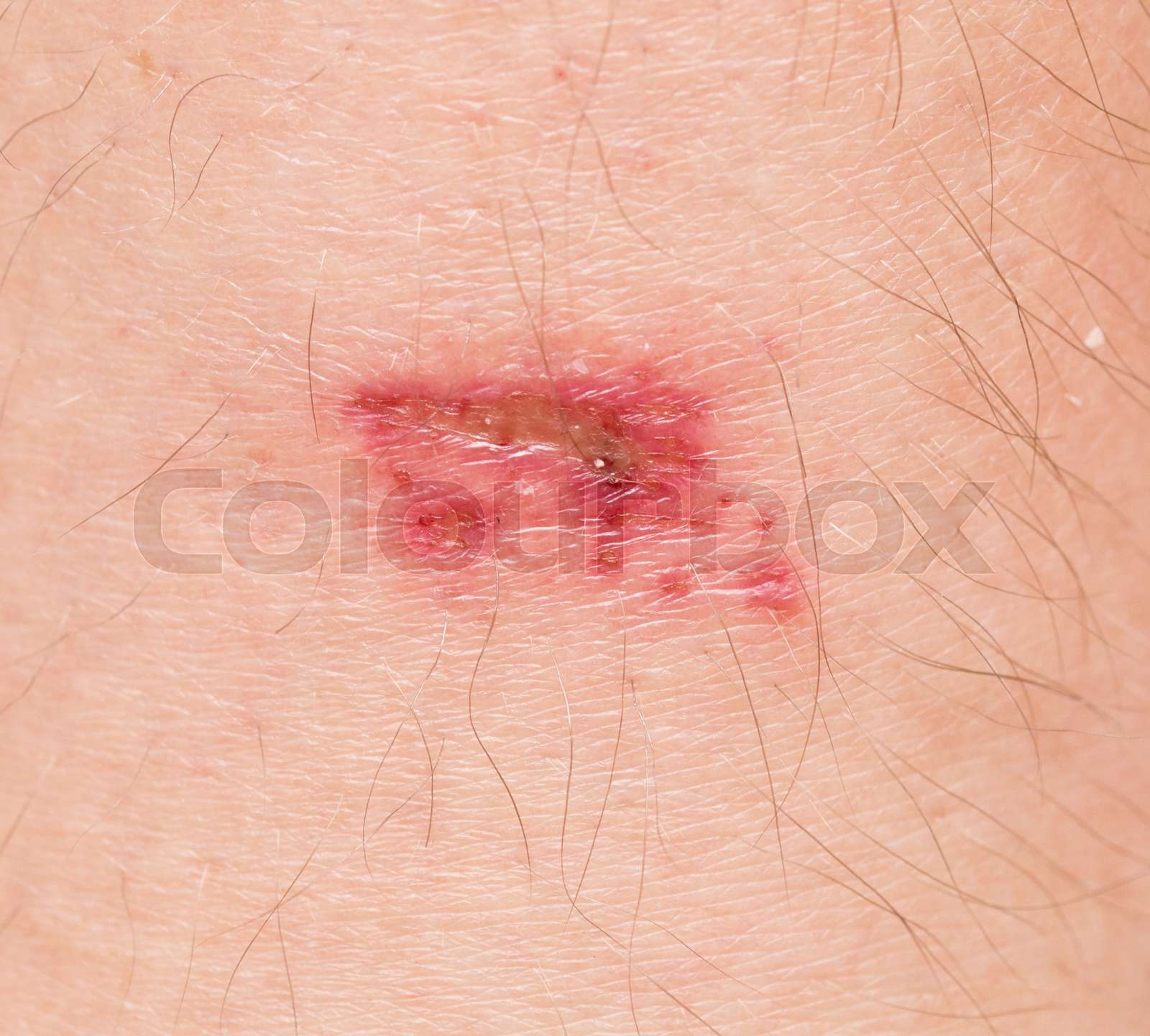 wound on skin | Stock image | Colourbox