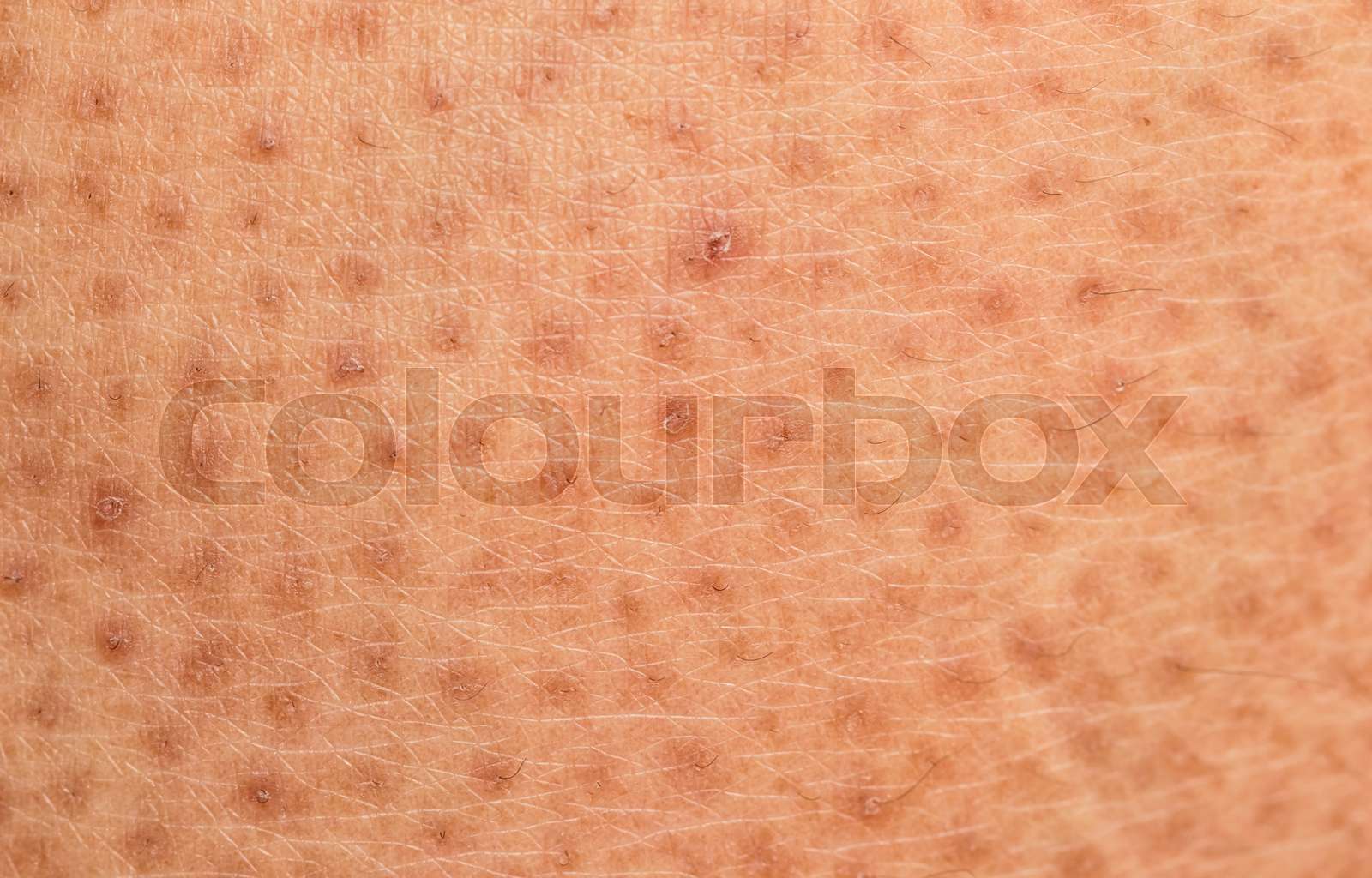 Closeup of skin problem,Dry skin ichthyosis vulgaris | Stock image ...