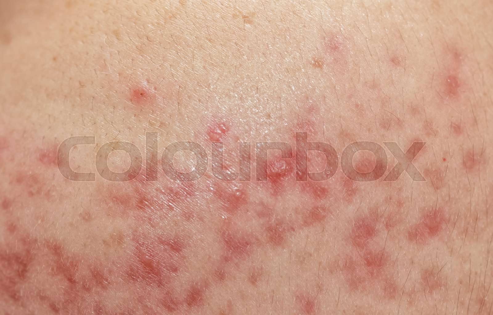 closeup skin problems, nodular cystic acne skin | Stock image | Colourbox