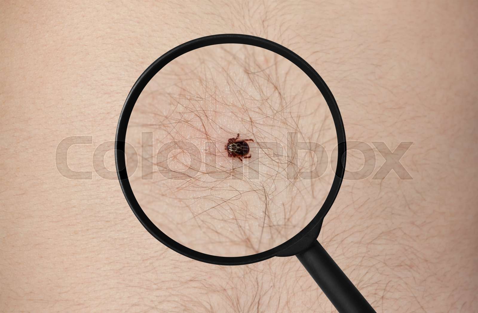 A large tick is sitting on the skin of a man, and magnified under a ...