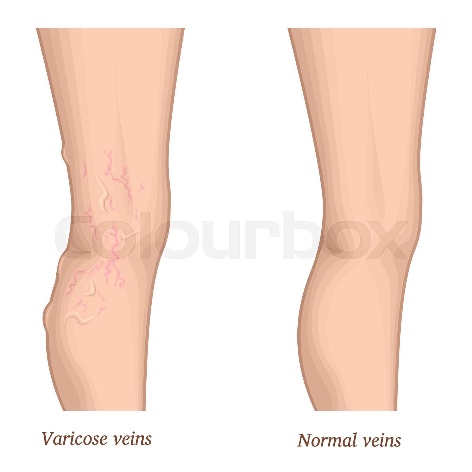 Illustration of varicose veins | Stock vector | Colourbox