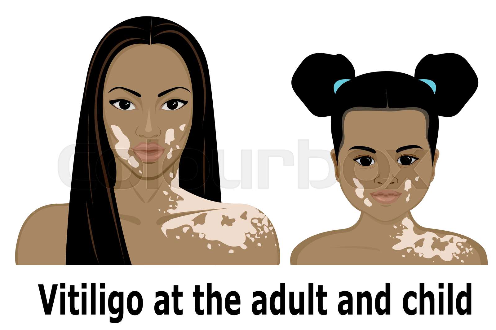 Vitiligo at the adult and child | Stock vector | Colourbox