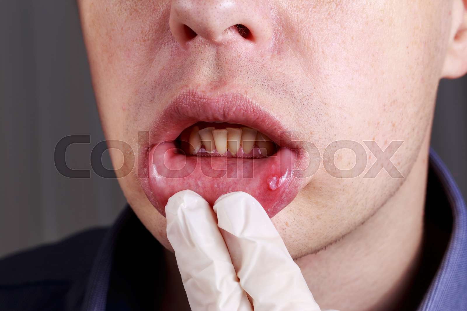 Stomatitis on the lips | Stock image | Colourbox