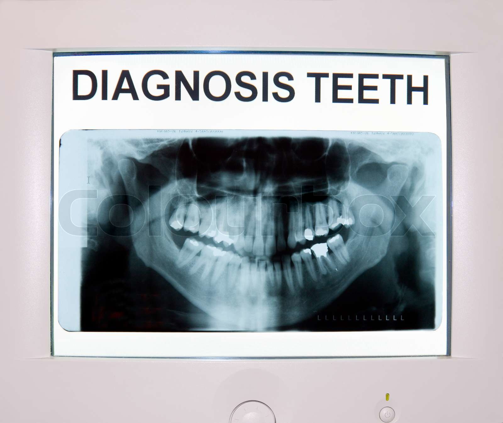 X-ray teeth on monitor | Stock image | Colourbox