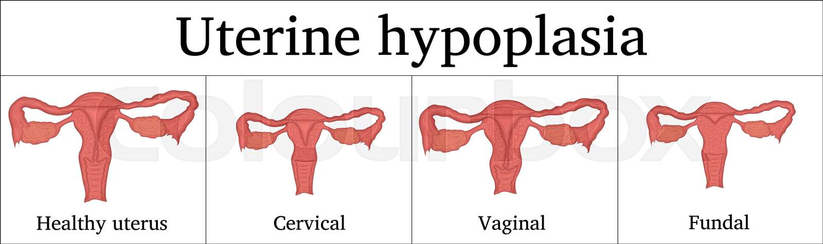 Illustration of Uterine hypoplasia | Stock vector | Colourbox