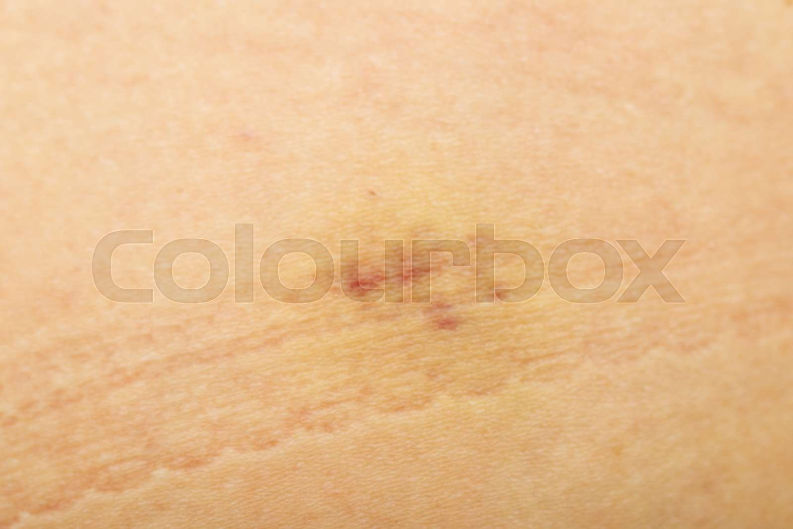bruise from injection | Stock image | Colourbox