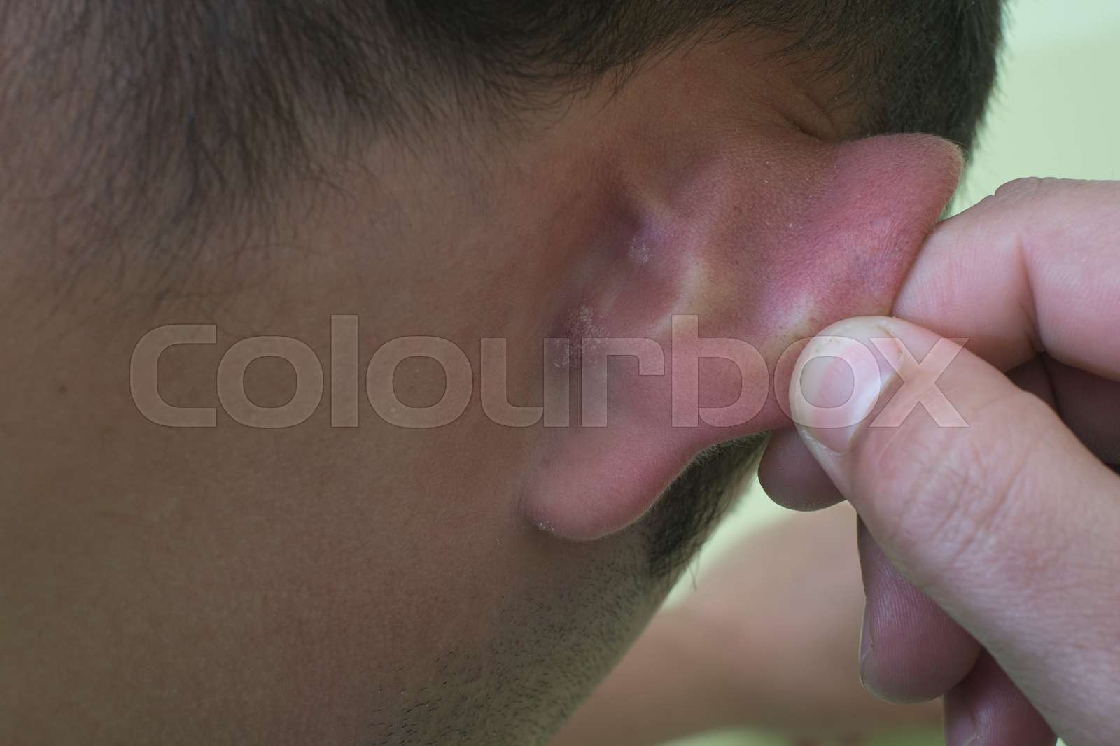 Psoriasis behind the ear, pushes the ear, dermatological problems, skin ...