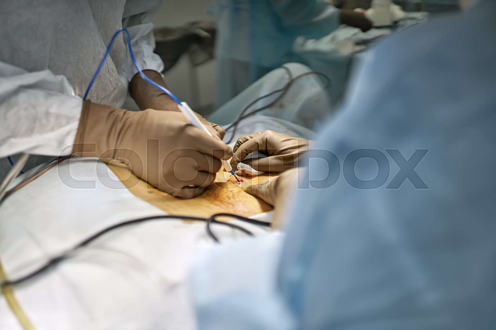 Laparoscopy operation process | Stock image | Colourbox