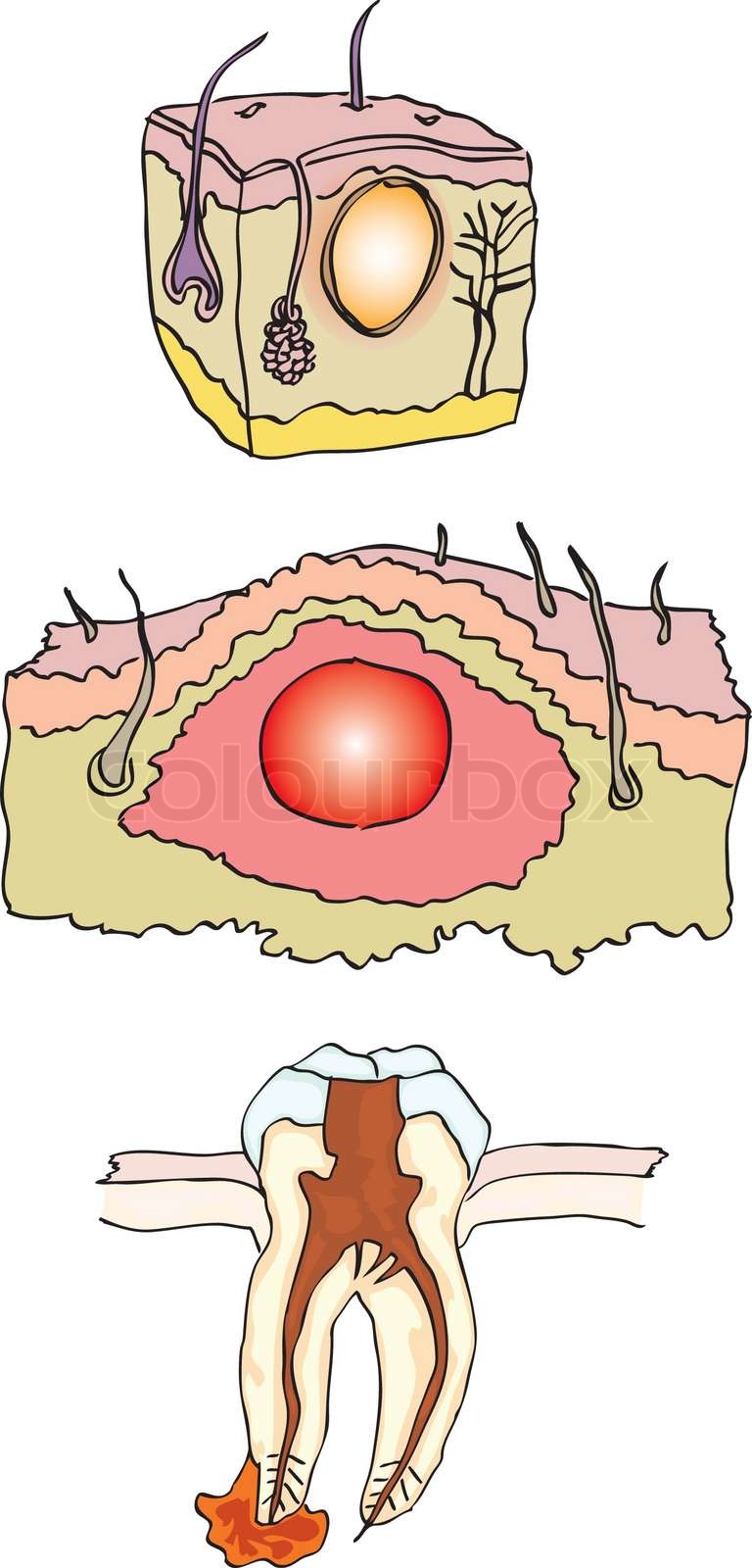 Vector illustration of an abscess, with the affected parts of the body ...
