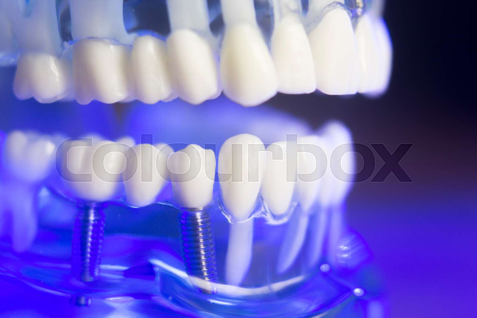 Dental alignment teeth model | Stock image | Colourbox