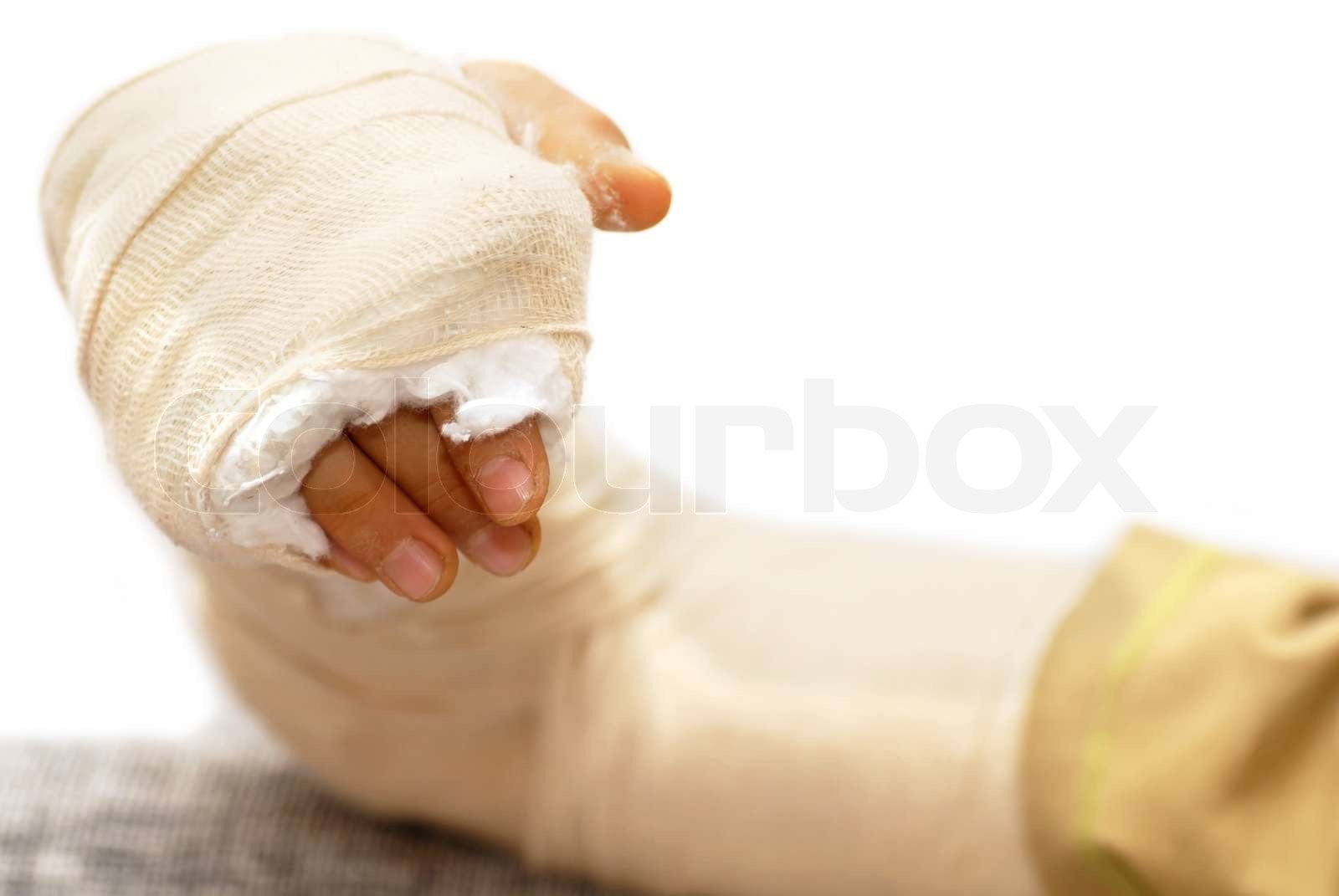 Gebrochener Arm | Stock Bild | Colourbox