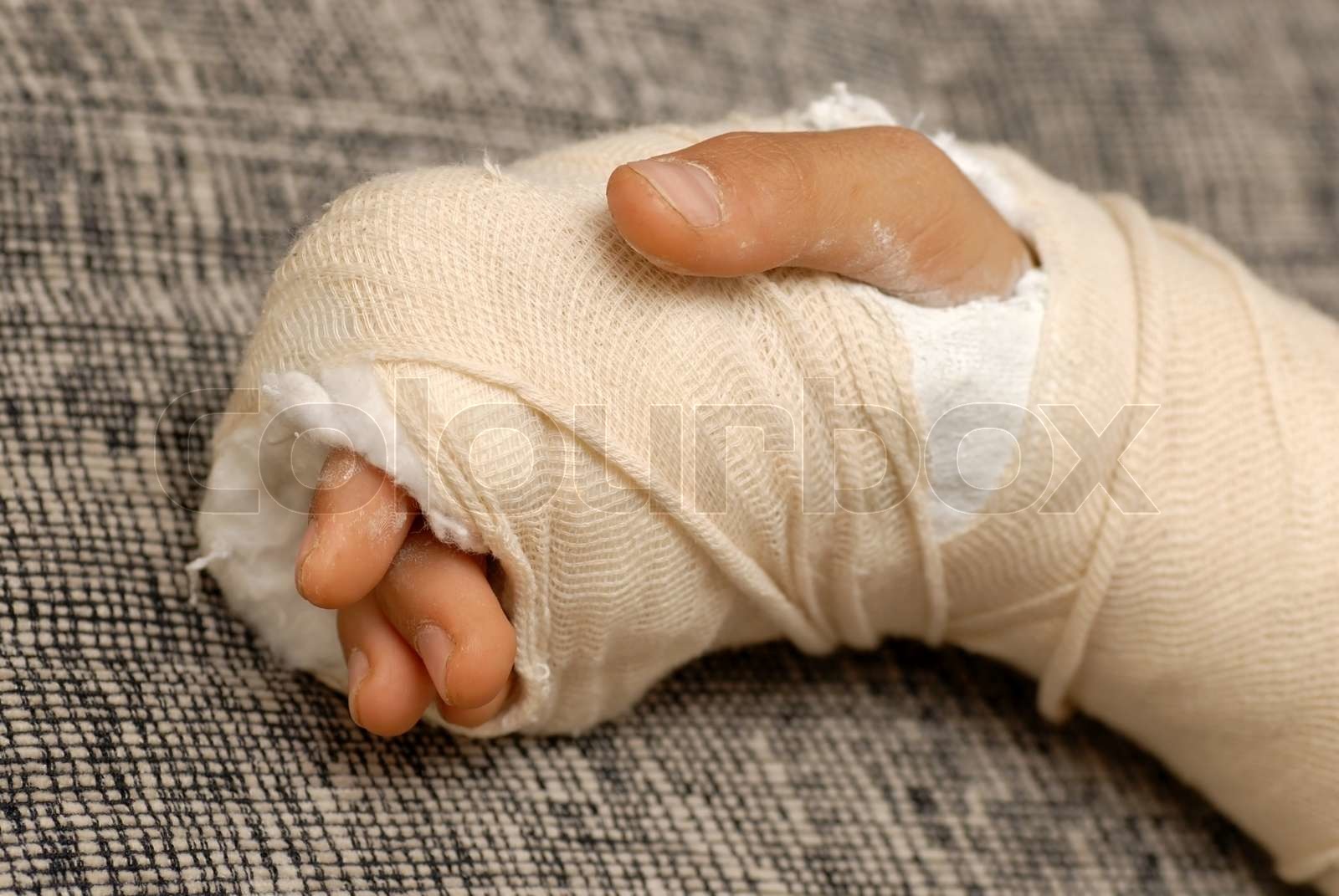 Broken arm | Stock image | Colourbox
