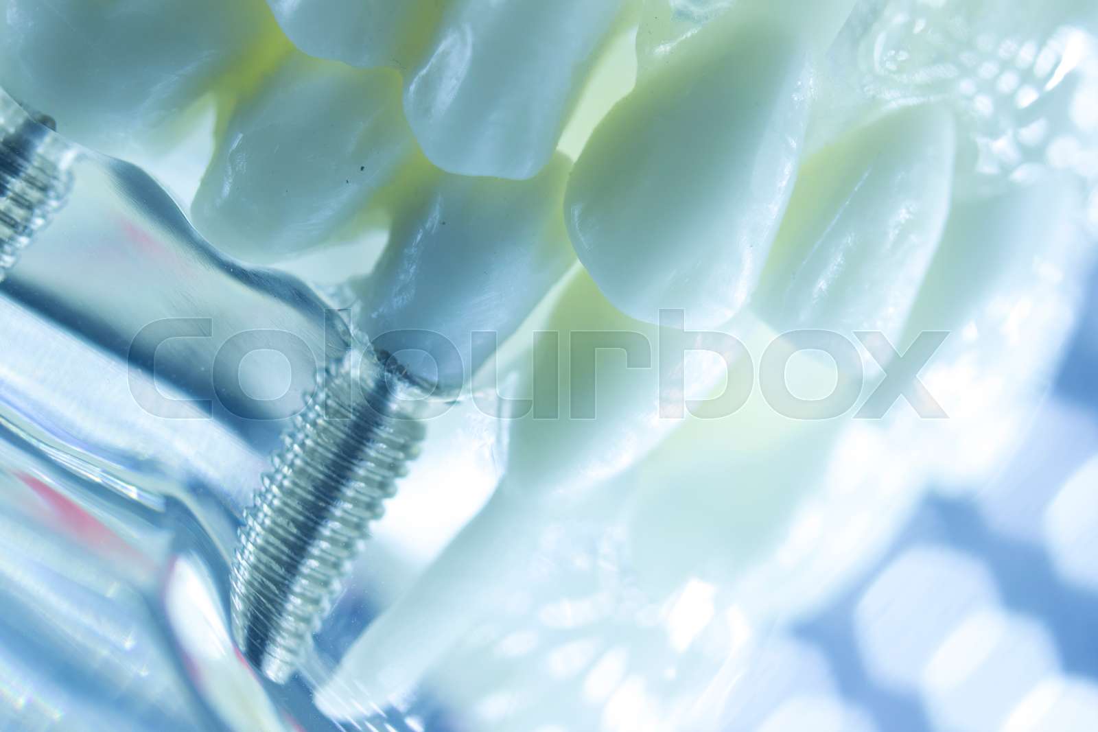 Dental titanium tooth implant | Stock image | Colourbox