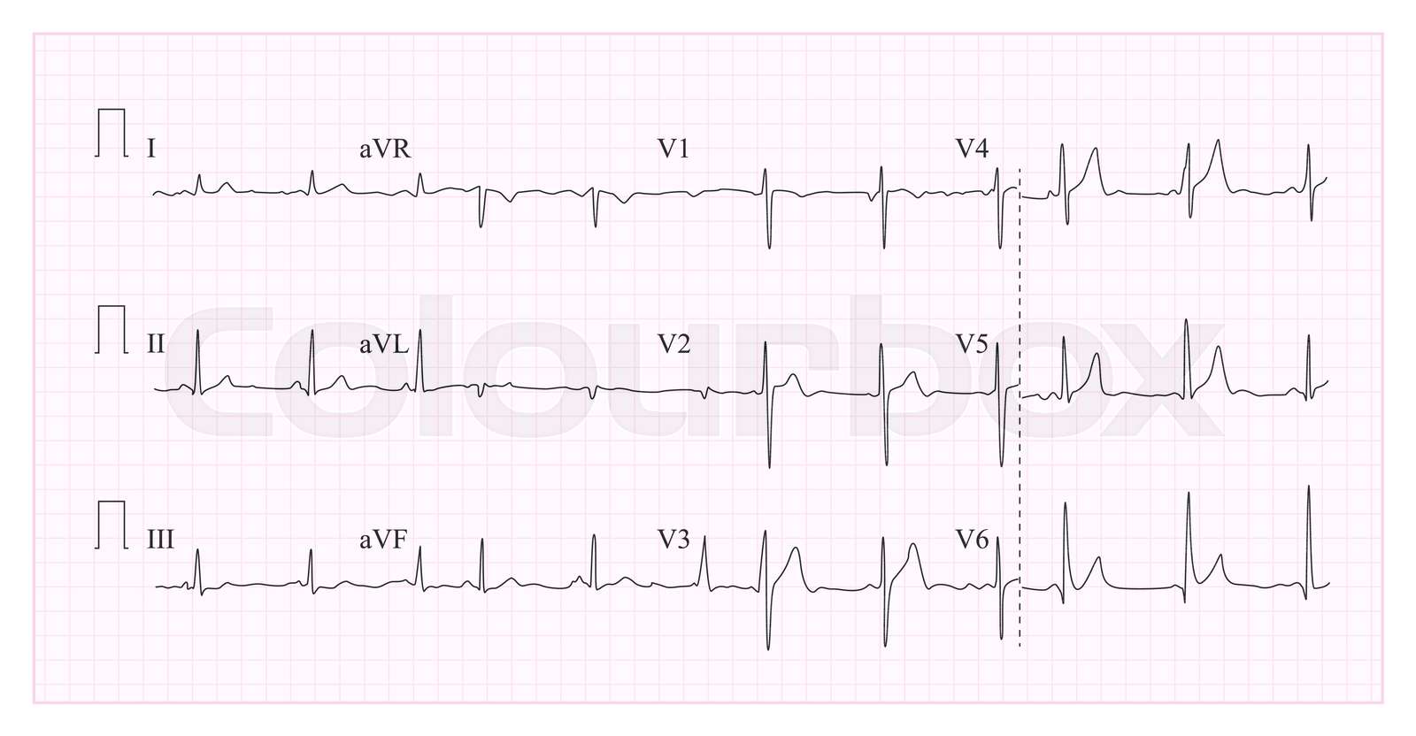 Heart Cardiogram Chart Vector. Illustration Of Wave Form On Checked Ecg ...