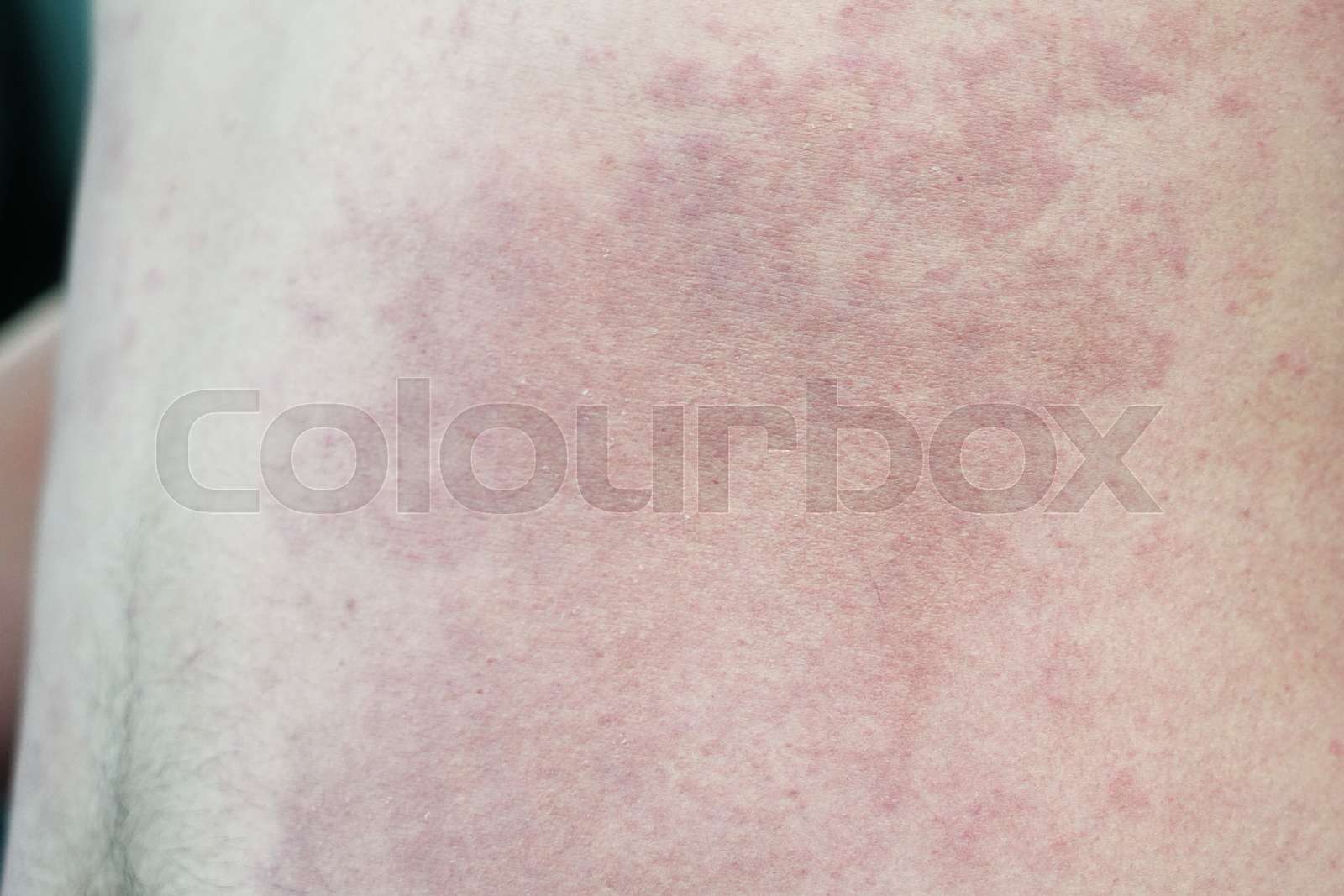 urticaria, udslæt, eksem | Stock foto | Colourbox