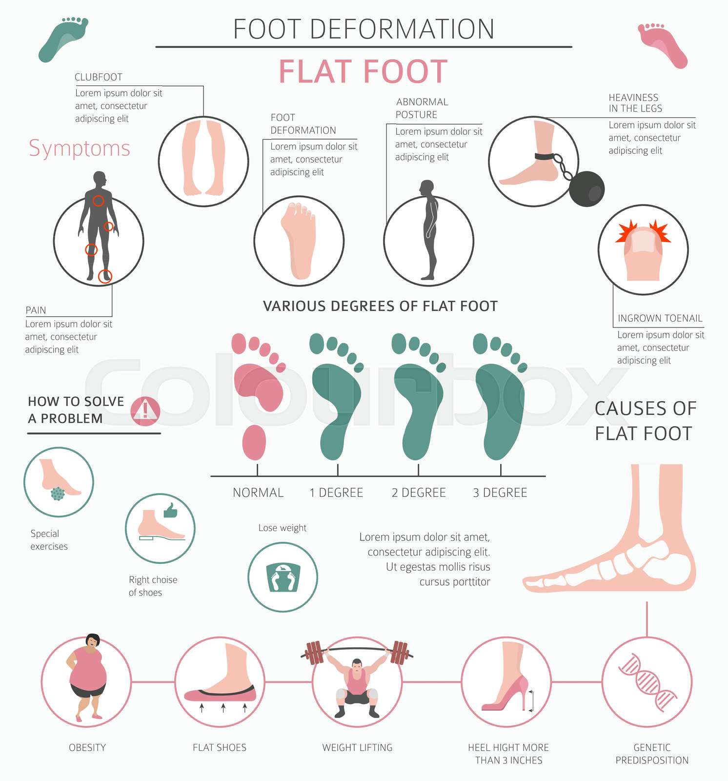 Foot deformation as medical desease infographic. Causes of Flat foot ...