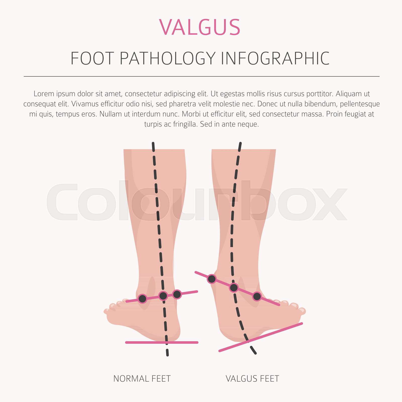 Foot deformation as medical desease infographic. Valgus and varus defect | Stock vector | Colourbox