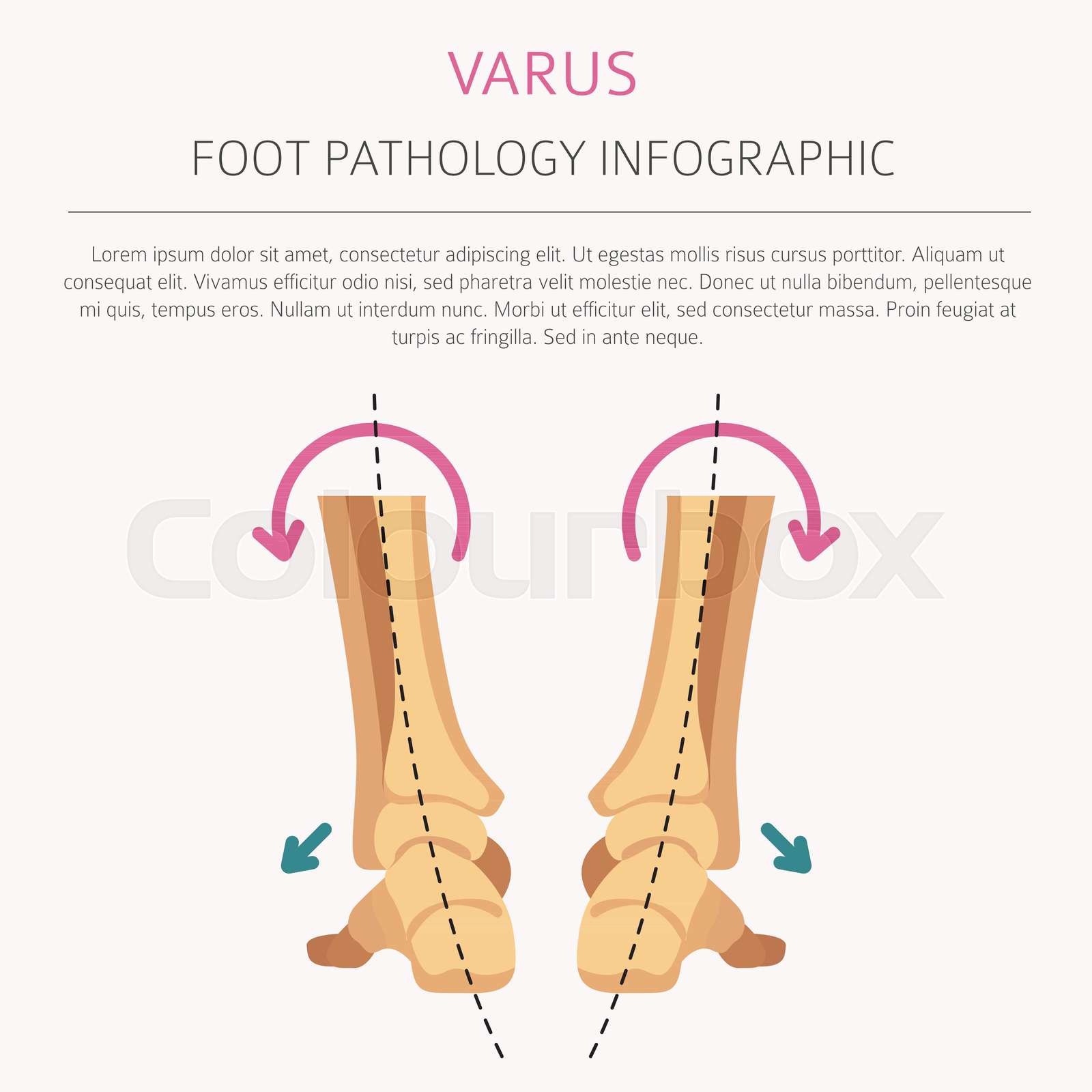 Foot deformation as medical desease infographic. Valgus and varus defect | Stock vector | Colourbox