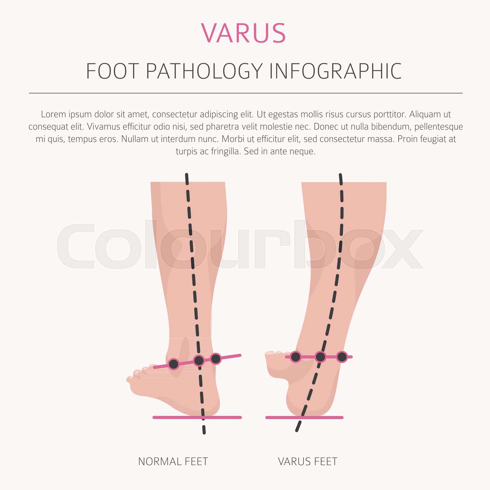 Foot deformation as medical desease infographic. Valgus and varus ...