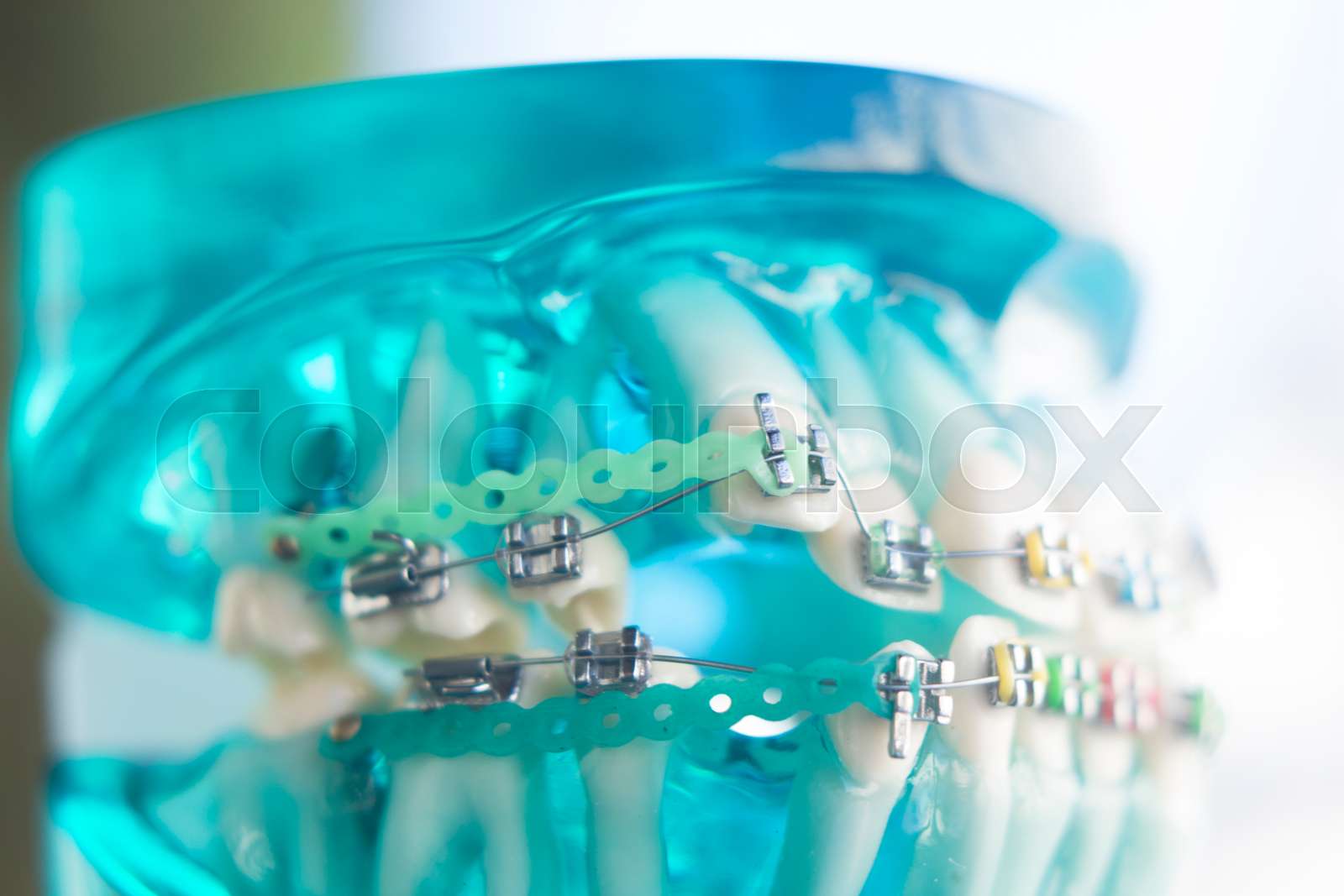 Dental teeth metal brackets | Stock image | Colourbox