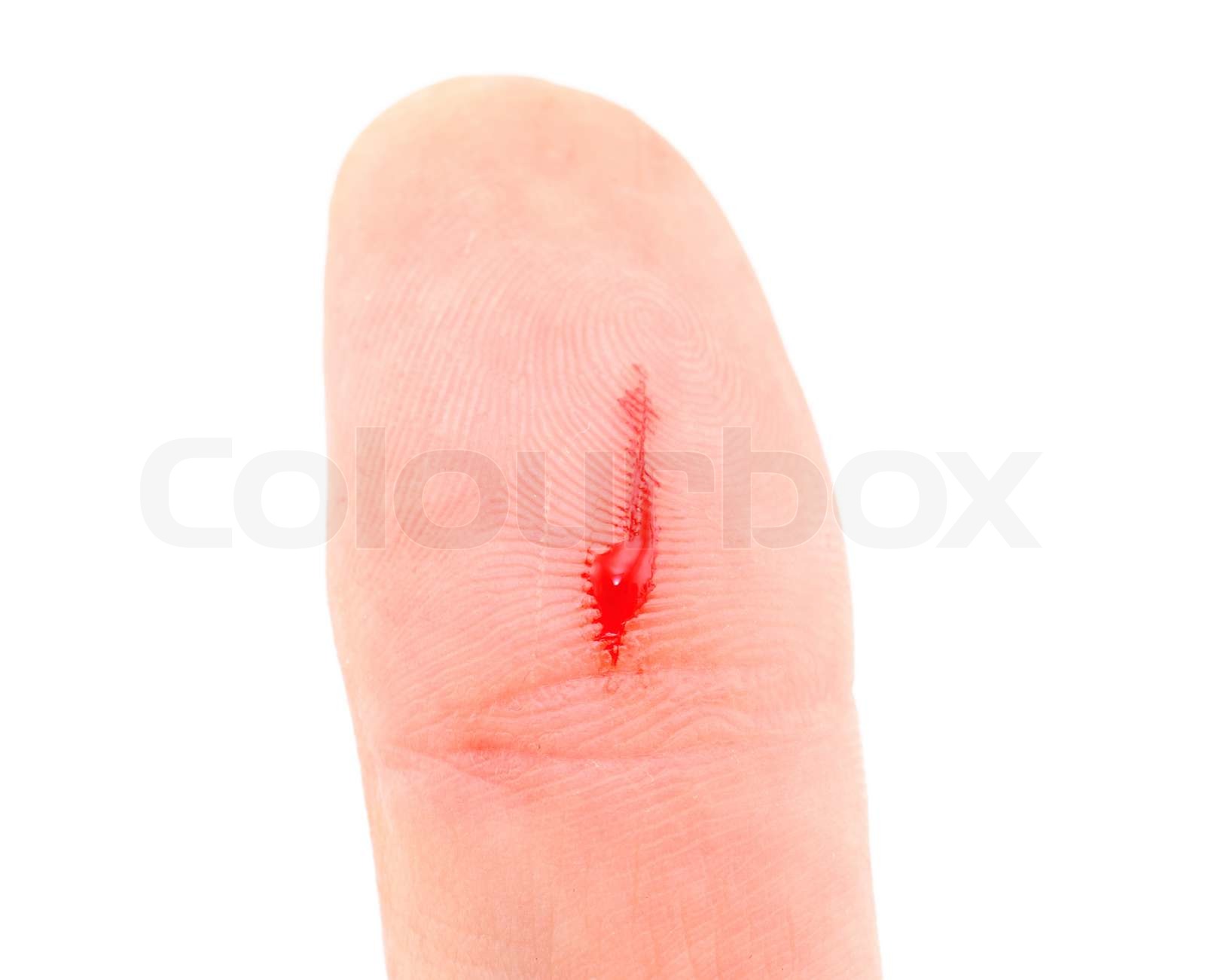 Bleeding thumb finger isolated on | Stock image | Colourbox