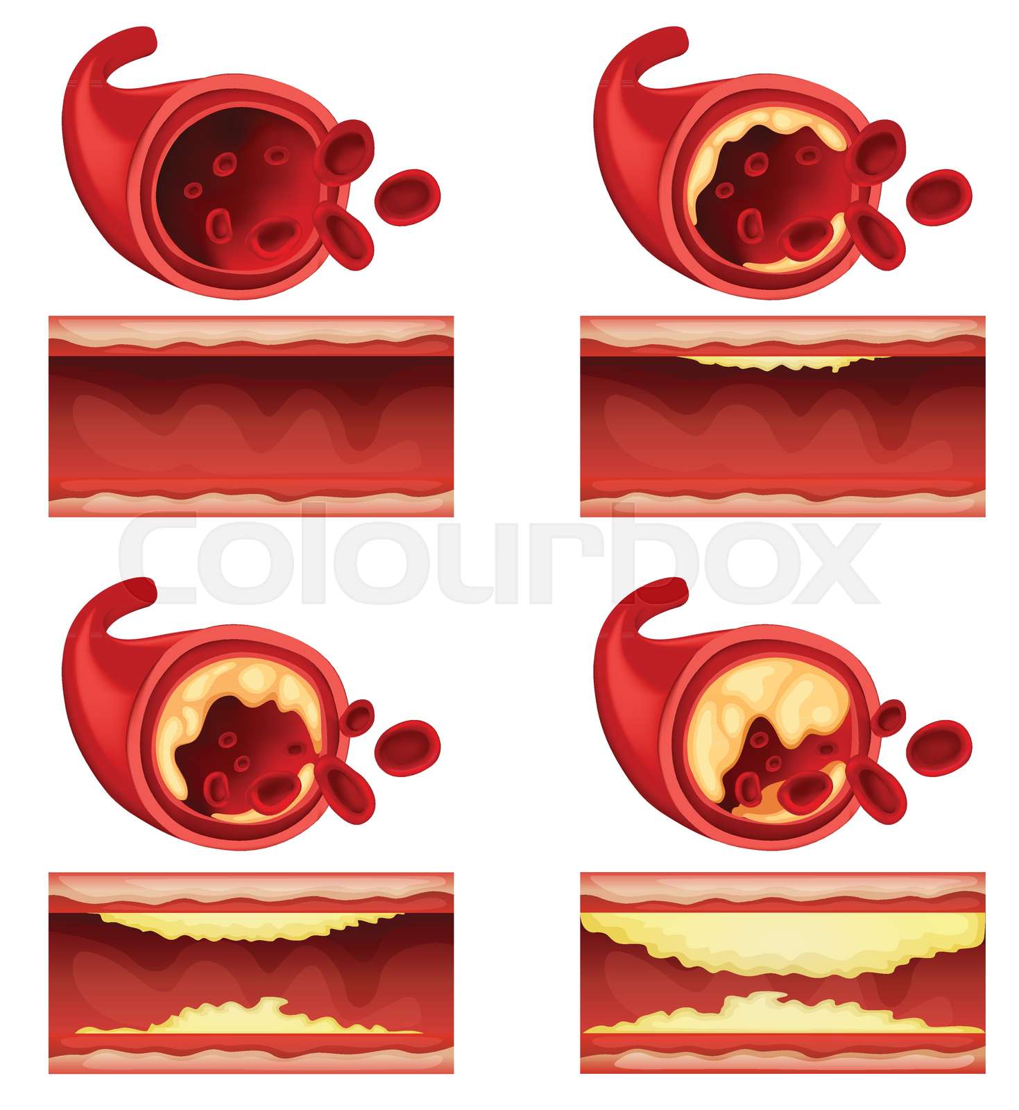 Diagram showing blood clot | Stock vector | Colourbox