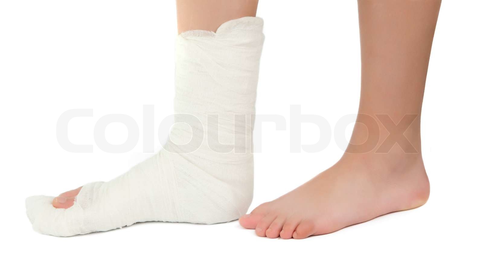 Bein in einem Gipsverband auf einem weißen Hintergrund | Stock Bild ...