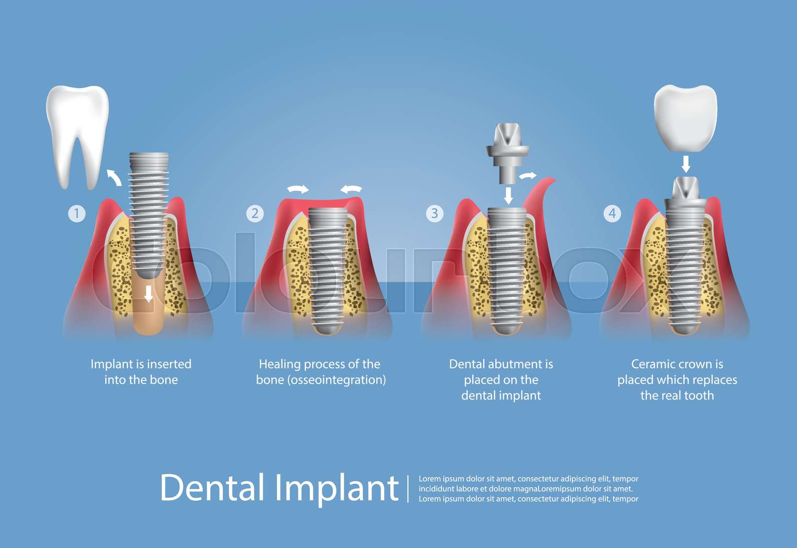 Human teeth and Dental implant Vector Illustration | Stock vector ...