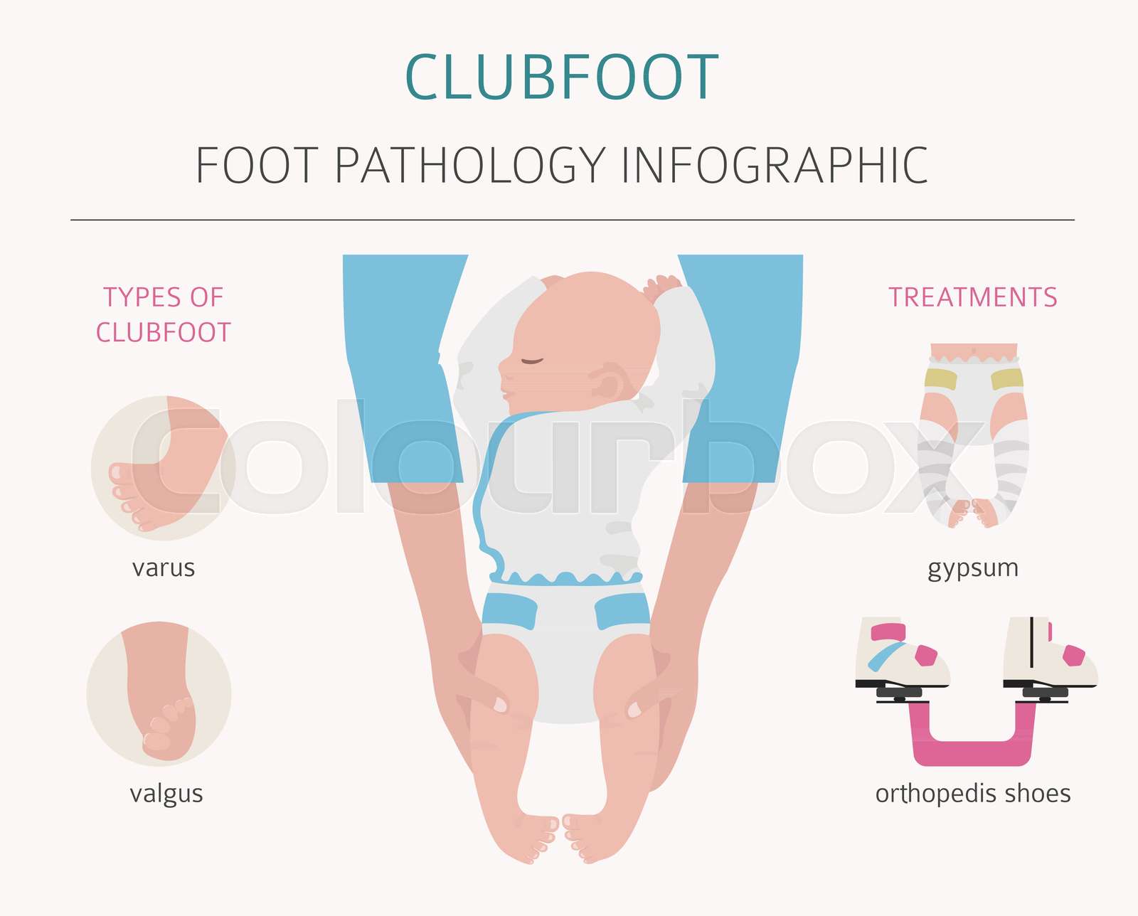 Foot deformation, medical desease infographic. Clubfoot defect | Stock ...