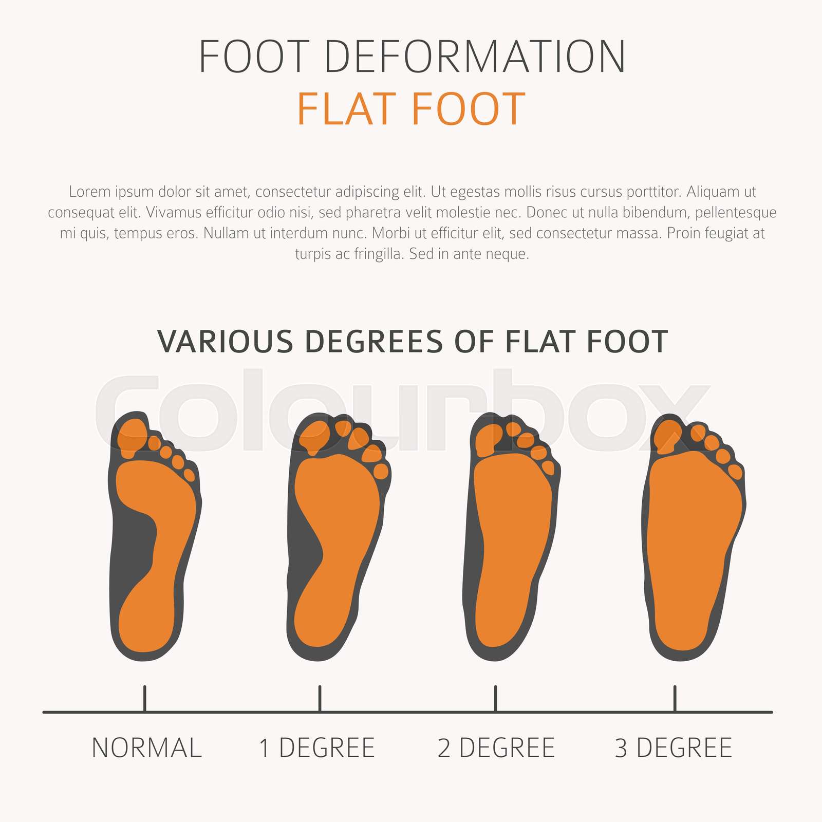 Foot deformation as medical desease infographic. Causes of Flat foot ...