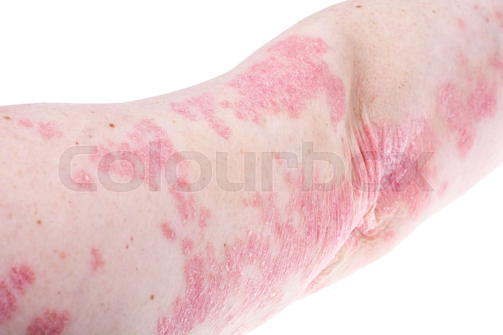 Dermatological Skin Disease Psoriasis More Pronounced On Elbow Hand