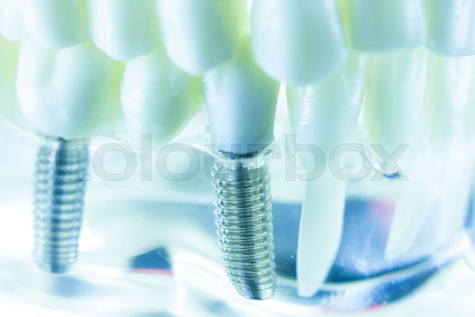 Dental titanium tooth implant | Stock image | Colourbox