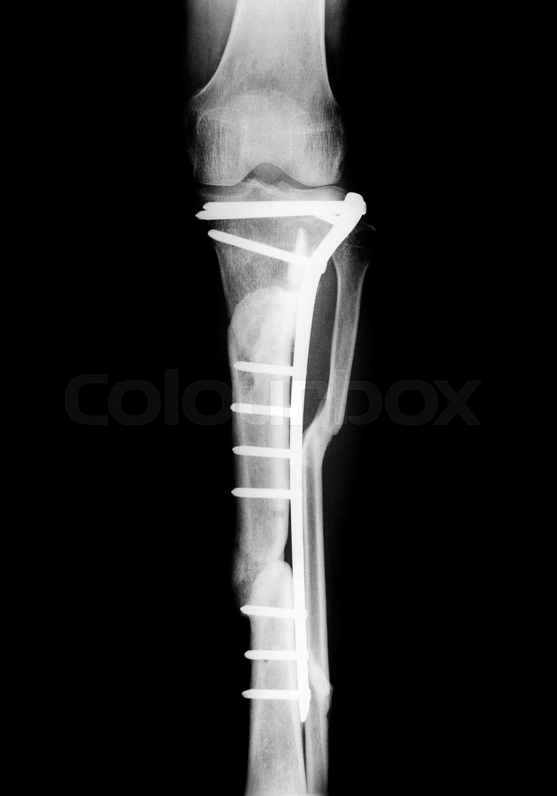 Film x-ray shinbone fracture. | Stock image | Colourbox